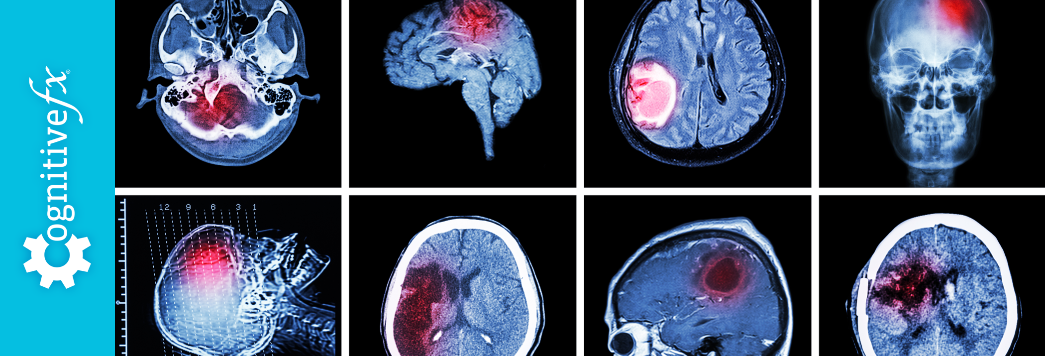 Differences Between Post Concussion Syndrome PCS Chronic Trauma